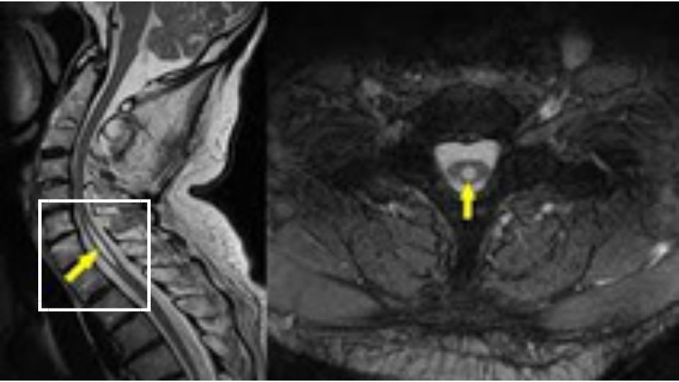 Siringomiyeli Nedir ? Belirtileri, Nedenleri, Tedavisi - DRCem