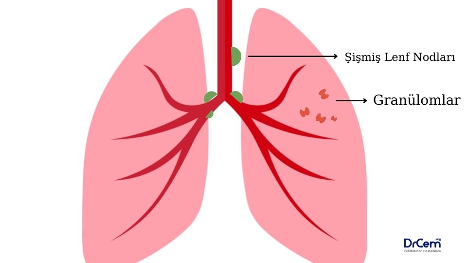 Sarkoidoz Nedir ? Belirtileri, Nedenleri, Tedavisi - DRCem