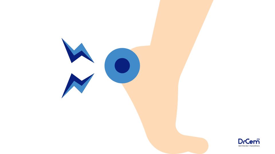 Plantar fasiit - Topuk Dikeni Nedir ? Belirtileri, Tedavisi - DRCem