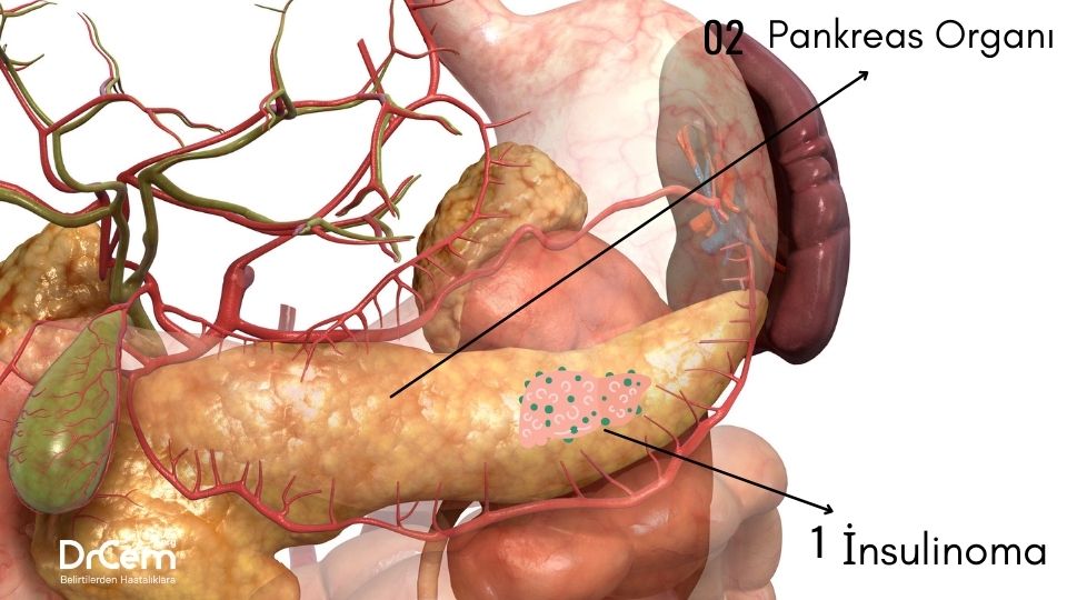İnsulinoma Nedir ? Belirtileri, Nedenleri, Tedavisi - DRCem