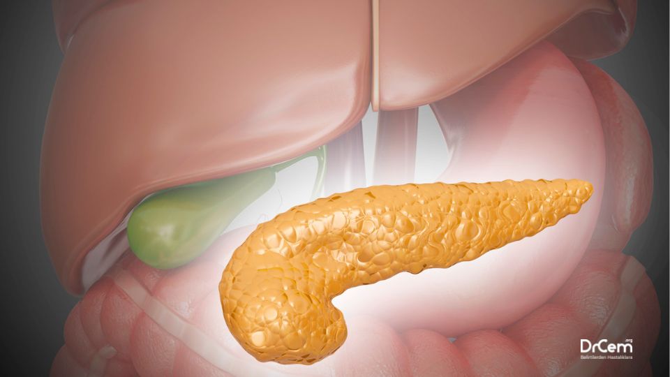 Pankreatit Nedir ? Belirtileri, Nedenleri, Tedavisi - DRCem