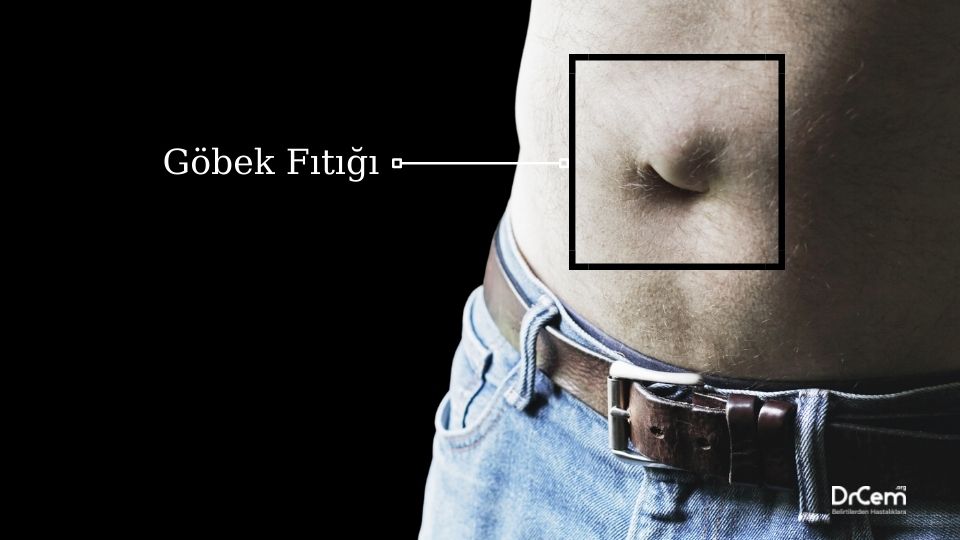 Karın Fıtıkları Ne Zaman Acildir ! Drcem
