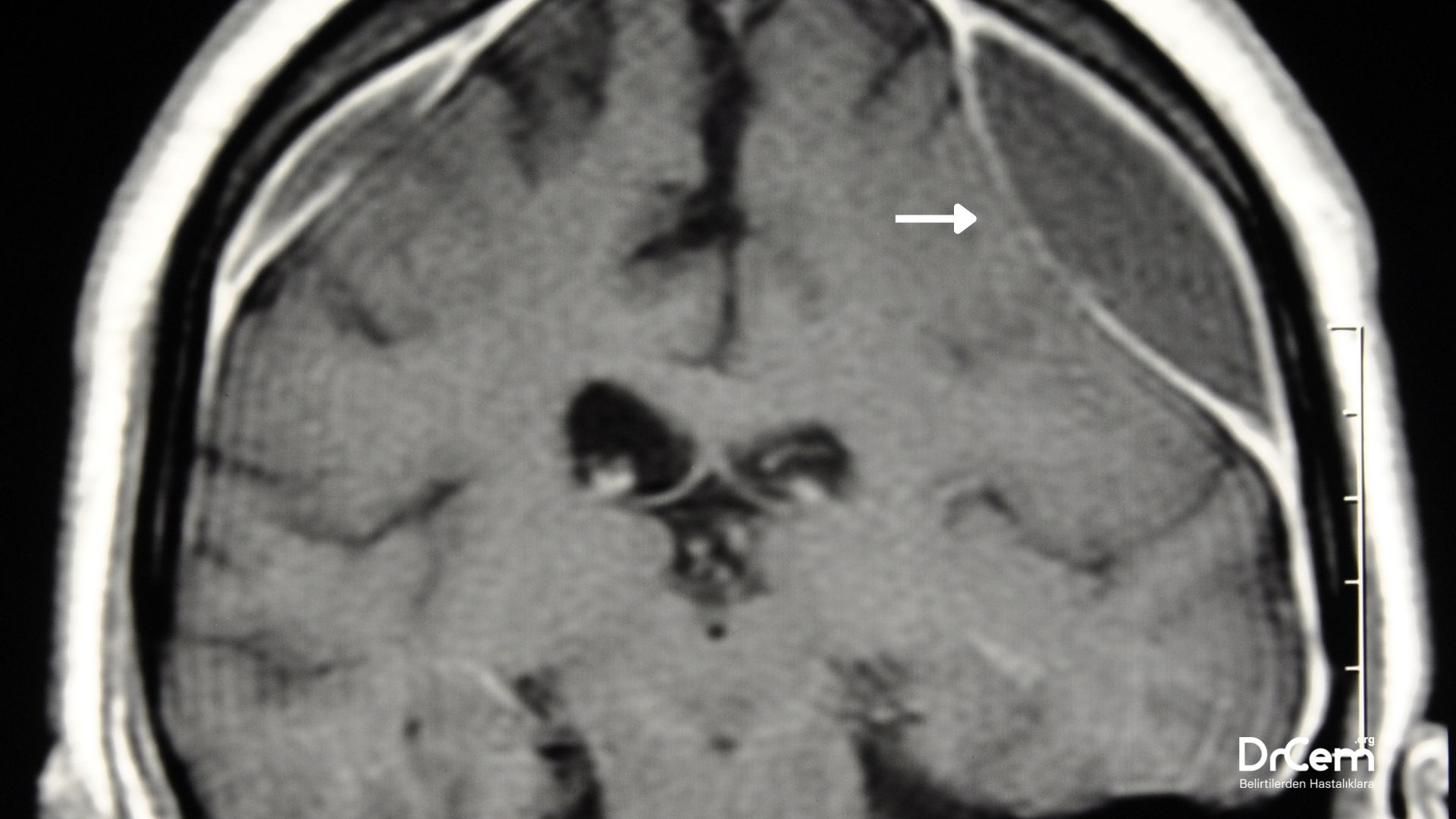 Subdural hematom Nedir ? Belirtileri, Nedenleri, Tedavisi - DRCem
