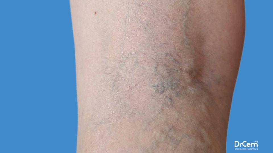 Varis Nedir ? Belirtileri, Nedenleri, Tedavisi - DRCem