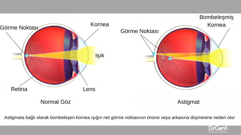 Astigmat Nedir ? Belirtileri, Nedenleri, Tedavisi - DRCem