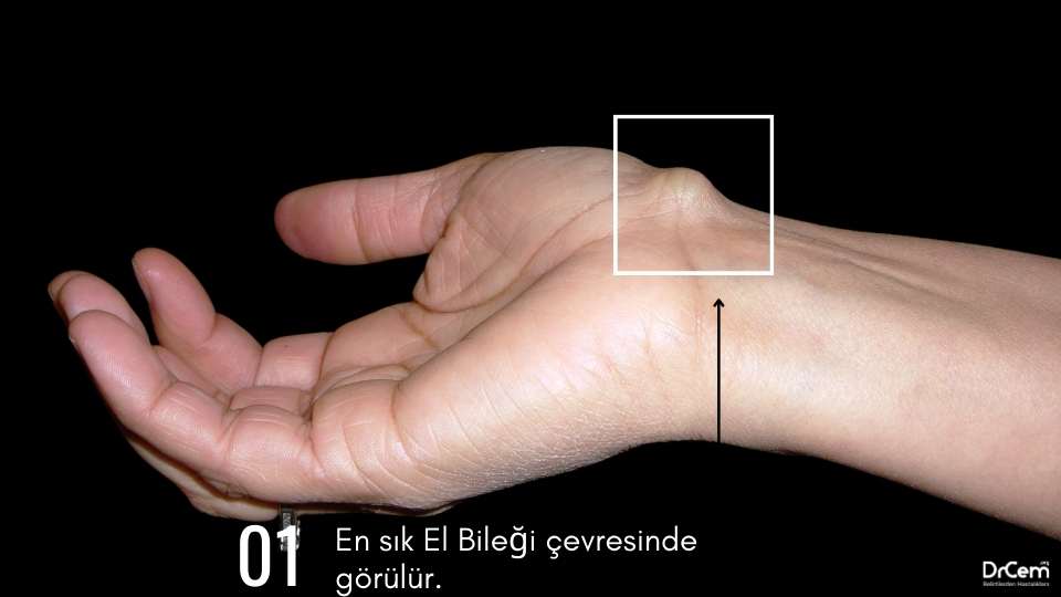 Ganglion kisti Nedir ? Belirtileri, Nedenleri, Tedavisi - DRCem